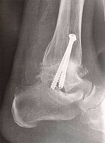 Chirurgien de la cheville, chirurgien orthopédiste Calais Dunkerque