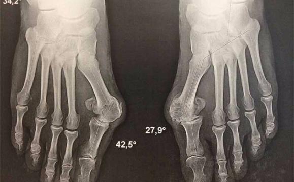 Chirurgie du pied hallux rigidus, chirurgie orthopédique Pas de Calais