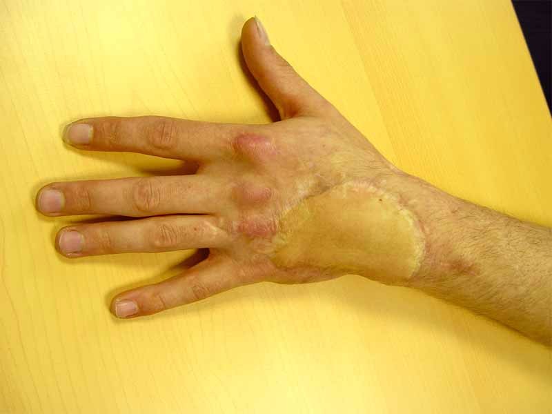 Chirurgie fracture de la main chirurgie, chirurgien main Calais